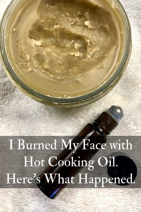 I Burned My Face with Hot Cooking Oil. Here’s What Happened ...